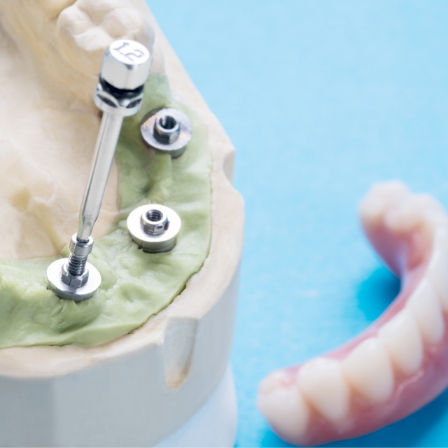 Big Benefits from Large-Scale Model Dental Implants! – Precision Guided ...